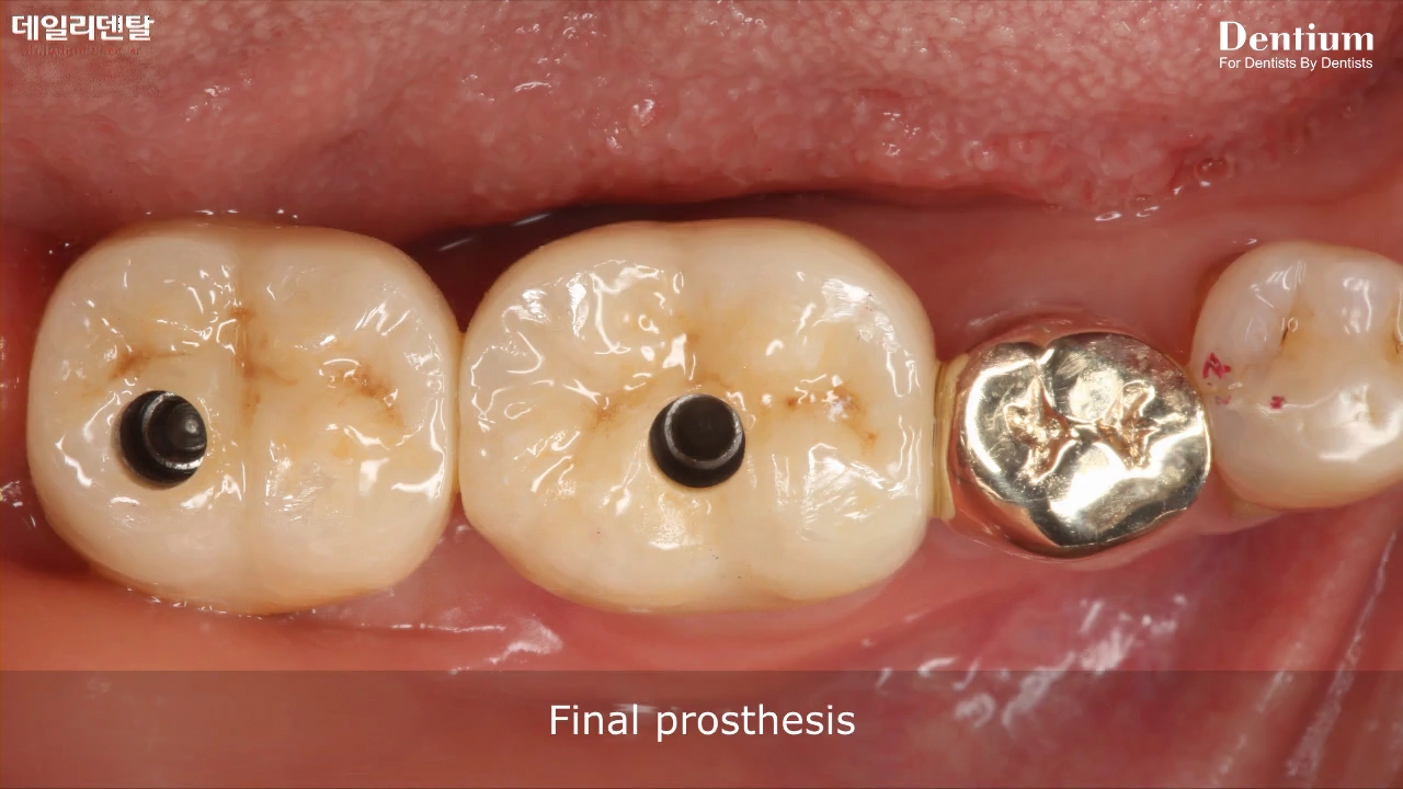 Ridge split on post Mandibular region using Dentium RS kit