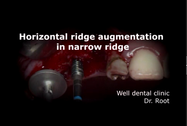 Horizontal ridge augmentation in narrow ridge