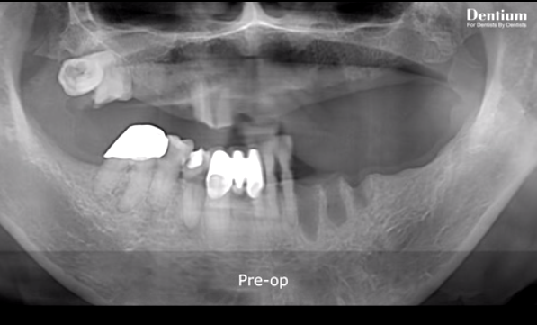 Overcoming buccal bone defect using Dentium regeneration materials (Short)