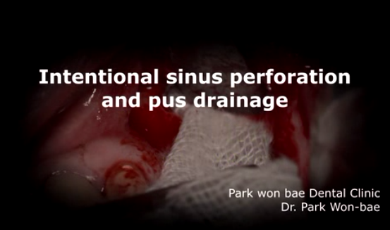 Intentional sinus perforation and pus drainage (Live)_Dr. Park Won-bae