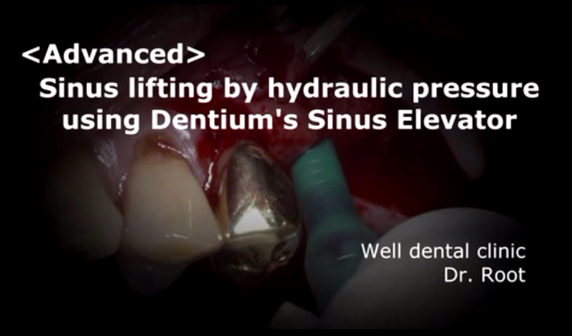 Sinus lifting by hydraulic pressure using Dentium's Sinus Elevator (Live)