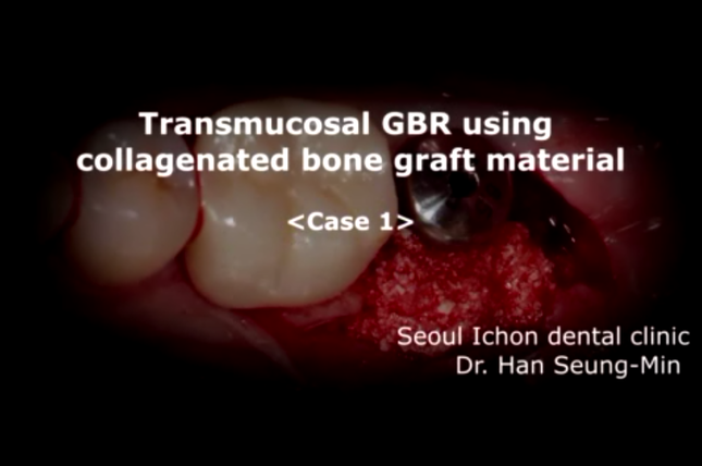 Transmucosal GBR using collagenated bone graft material-Dr. Han Seung-Min