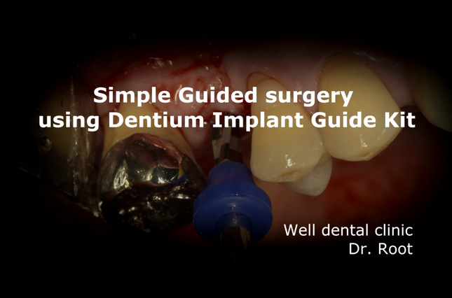 Simple Guided surgery using Dentium Implant Guide Kit
