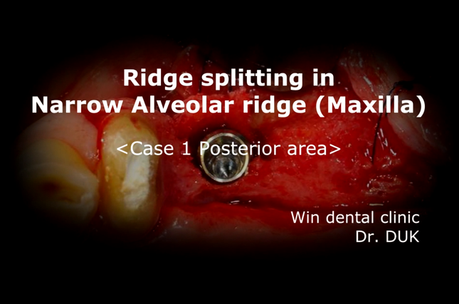 Ridge splitting in Narrow alveolar ridge (Maxilla) - Dr. DUK