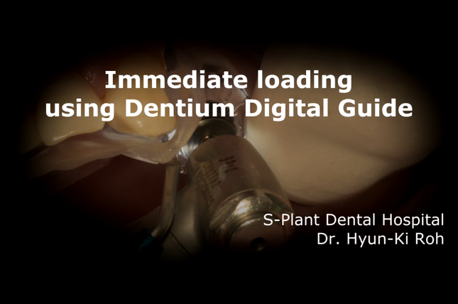 Immediate loading using Dentium Digital Guide - Dr. Hyun-Ki Roh