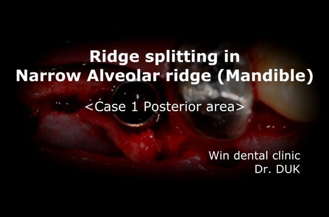 Ridge splitting in narrow alveolar ridge (Mandible)-Dr.DUK