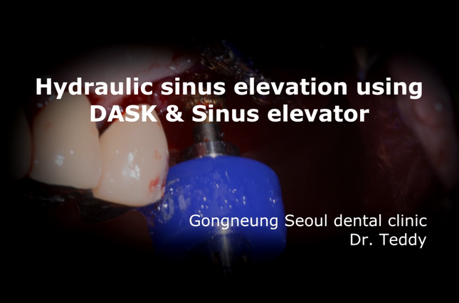 Hydraulic sinus elevation using DASK & Sinus elevator - Dr. Teddy