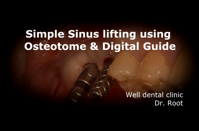 Simple Sinus lifting using Osteotome & Digital Guide