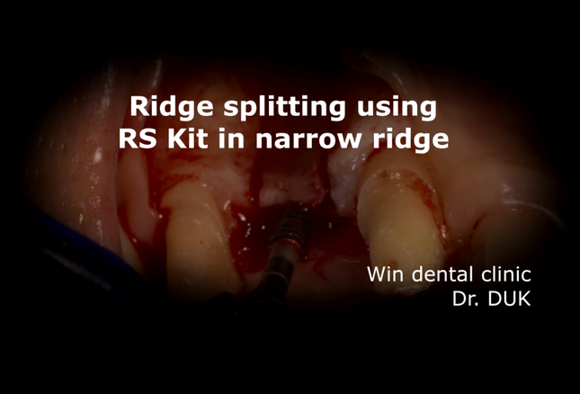 Ridge splitting using RS Kit in narrow ridge_Dr.DUK