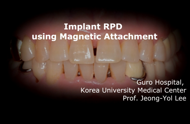 Implant RPD using Magnetic Attachment_Prof. Jeong-Yol Lee