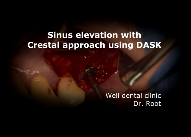 Sinus elevation with Crestal approach using DASK